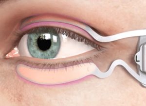 Dry Eye Services | Carmel Lasik | Center for Sight