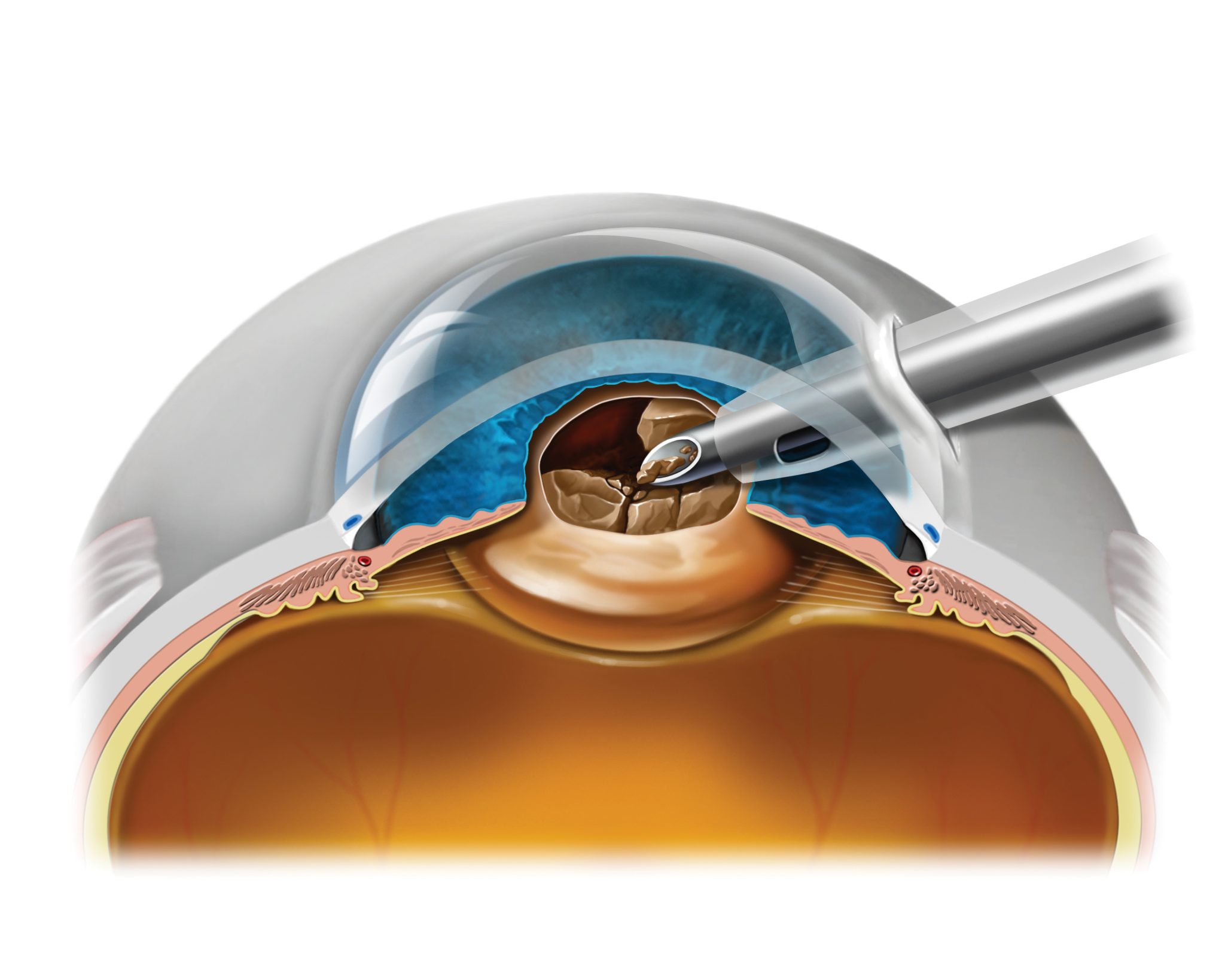 Cataracts | Carmel Lasik | Center for Sight
